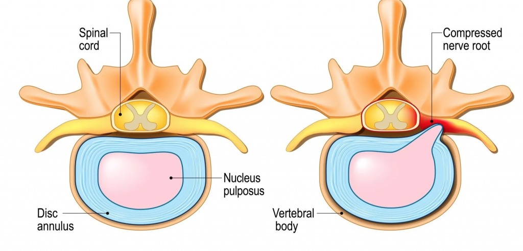 Compressed nerve root - North Shore Chiropractic